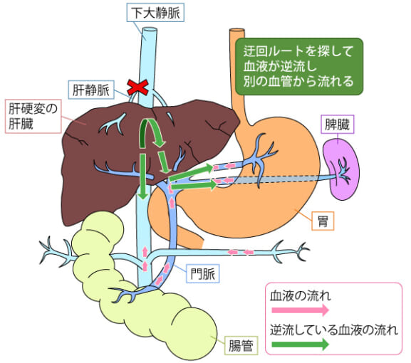 バッド・キアリ症候群 (ばっどきありしょうこうぐん)とは | 済生会
