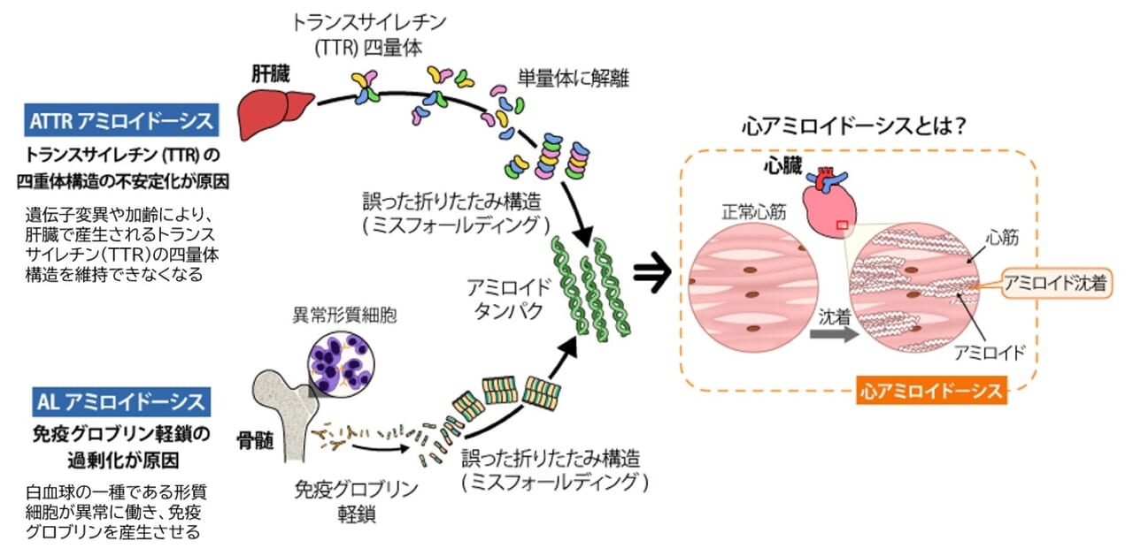 心アミロイドーシス (しんあみろいどーしす)とは | 済生会