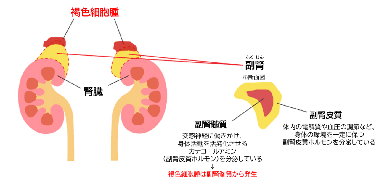 褐色細胞腫 (かっしょくさいぼうしゅ)とは | 済生会